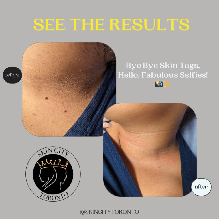 DPN / SKIN TAGS - Skin City Spa